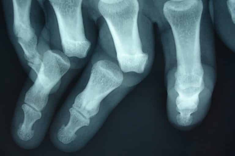 Chirurgie des doigts de la main et du pouce - Chirurgie orthopédique ...