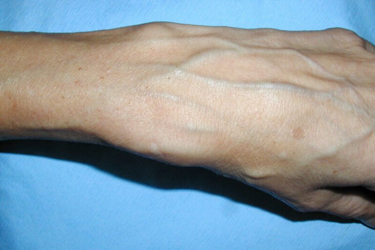 Tendinite de de Quervain - Tendinite du poignet à la base du pouce