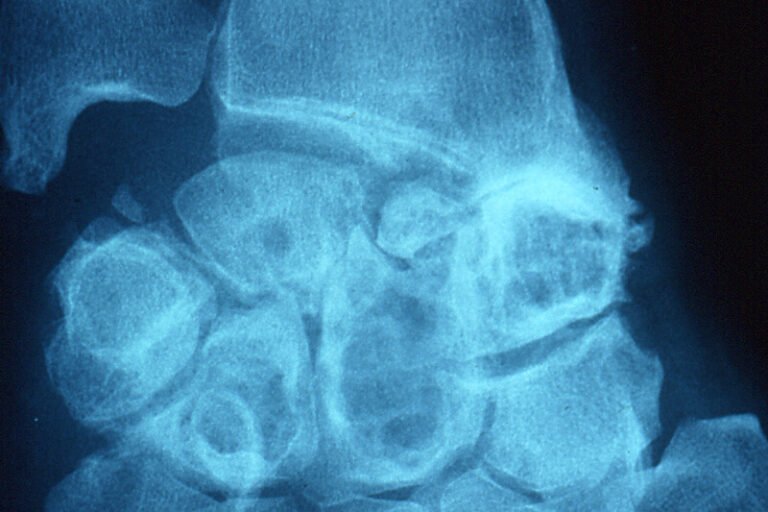 Tendinite de de Quervain - Tendinite du poignet à la base du pouce