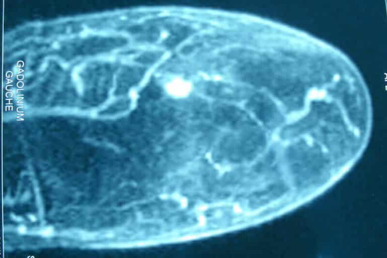 Maladie des doigts de la main et maladie du pouce | Pathologie des ...