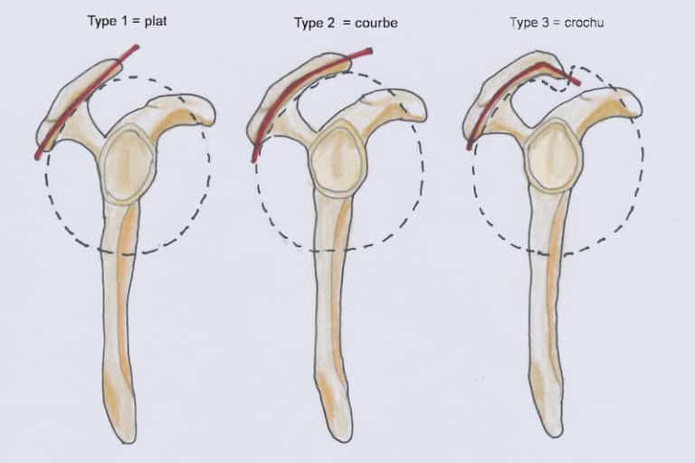 Acromion qui ressort ou agressif | Anatomie épaule | Pr Eric Roulot
