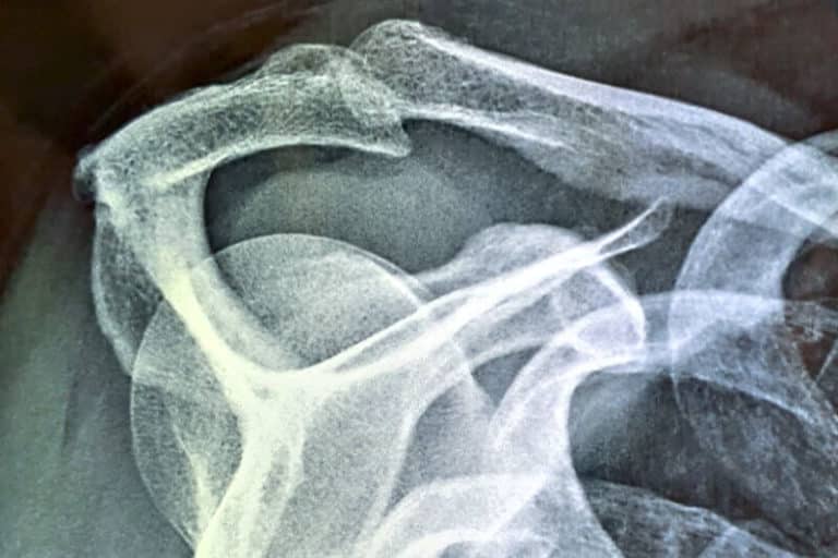 Acromion qui ressort ou agressif | Anatomie épaule | Pr Eric Roulot