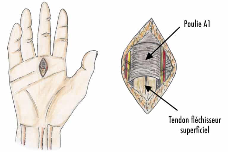 Opération doigt à ressaut - Chirurgie, convalescence, complications et ...