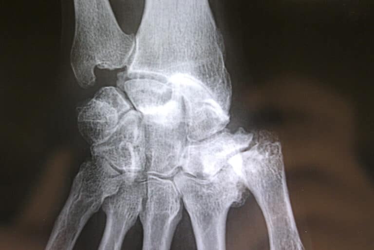 Rhizarthrose, une arthrose à la base du pouce | Pr Eric Roulot ...