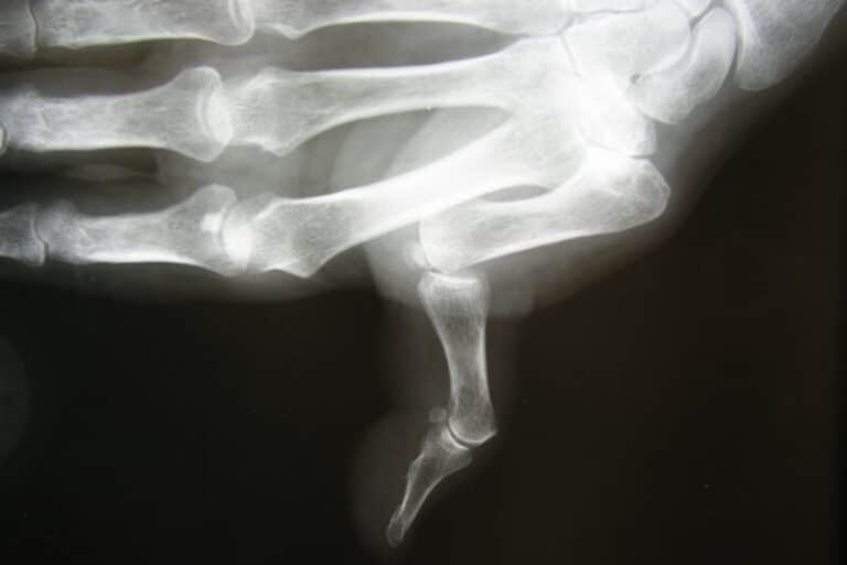 Rhizarthrose, une arthrose à la base du pouce | Pr Eric Roulot ...