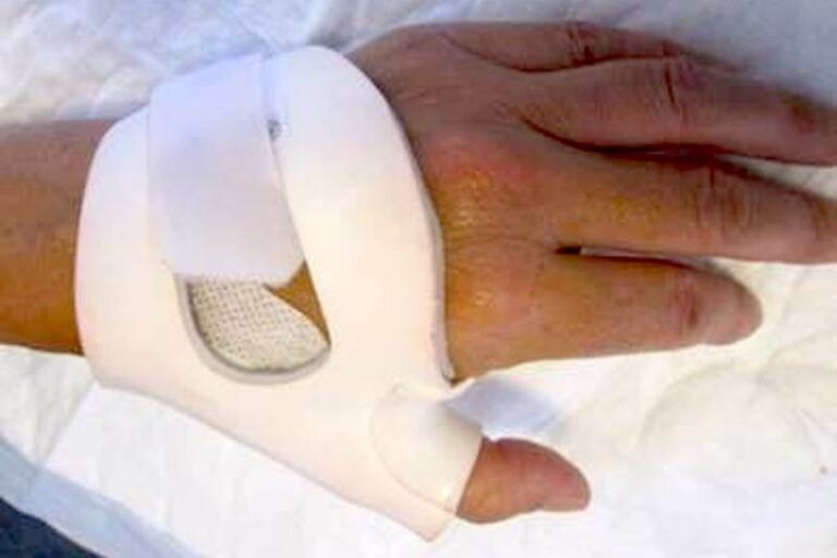 Trapézectomie partielle ou totale | Chirurgie des doigts de la main ...