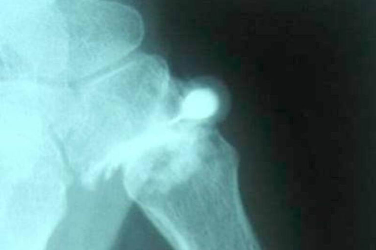 Rhizarthrose, une arthrose à la base du pouce | Pr Eric Roulot ...