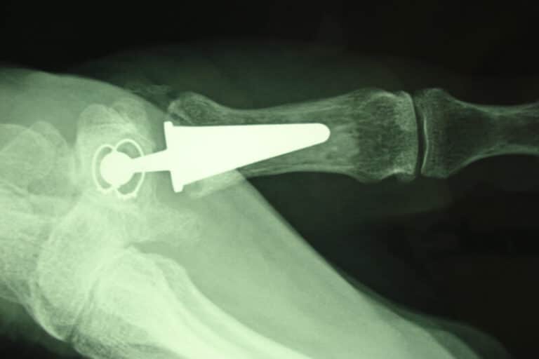 Rhizarthrose, une arthrose à la base du pouce | Pr Eric Roulot ...