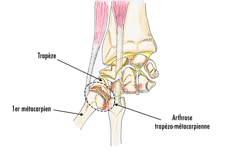 Rhizarthrose, une arthrose à la base du pouce | Pr Eric Roulot ...