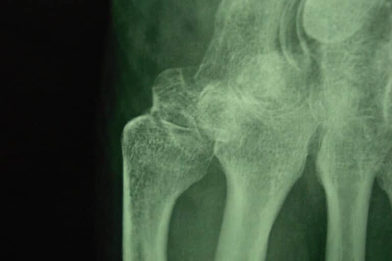 Rhizarthrose, une arthrose à la base du pouce | Pr Eric Roulot ...