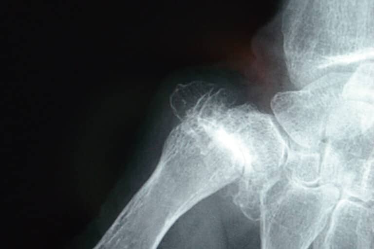 Rhizarthrose, une arthrose à la base du pouce | Pr Eric Roulot ...