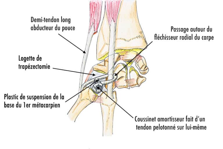 Trapézectomie partielle ou totale | Chirurgie des doigts de la main ...