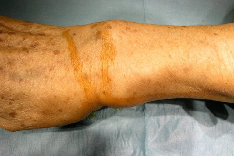Rhizarthrose, une arthrose à la base du pouce | Pr Eric Roulot ...