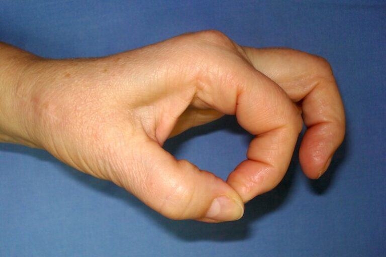 Trapézectomie partielle ou totale | Chirurgie des doigts de la main ...