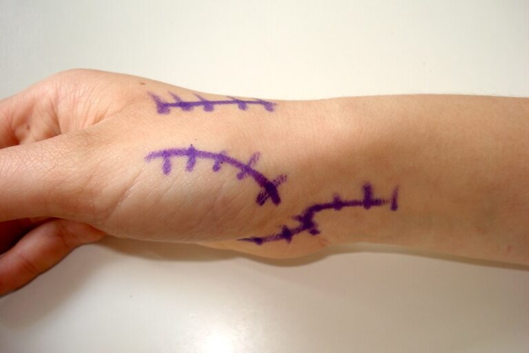 Rhizarthrose, une arthrose à la base du pouce | Pr Eric Roulot ...