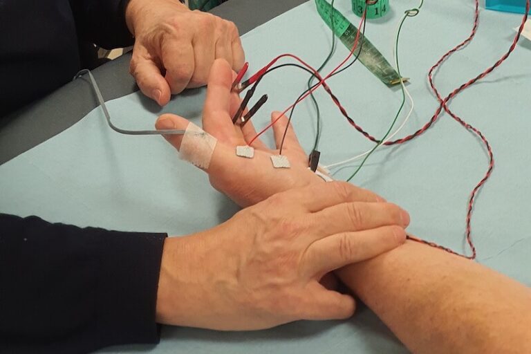 Nerf ulnaire au coude (nerf cubital) - Trajet, compression, libération ...