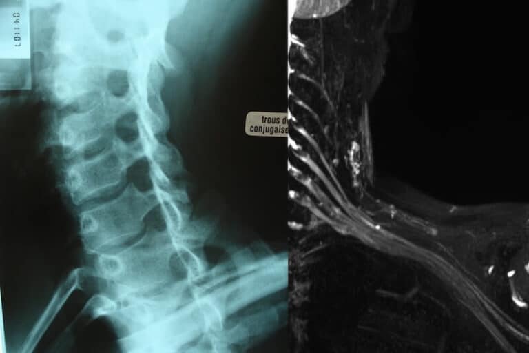 Nerf ulnaire au coude (nerf cubital) - Trajet, compression, libération ...