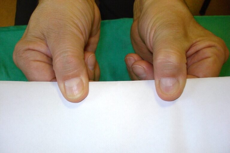 Nerf ulnaire au coude (nerf cubital) - Trajet, compression, libération ...