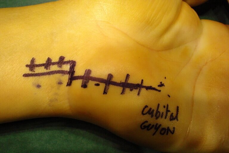 Nerf ulnaire au coude (nerf cubital) - Trajet, compression, libération ...