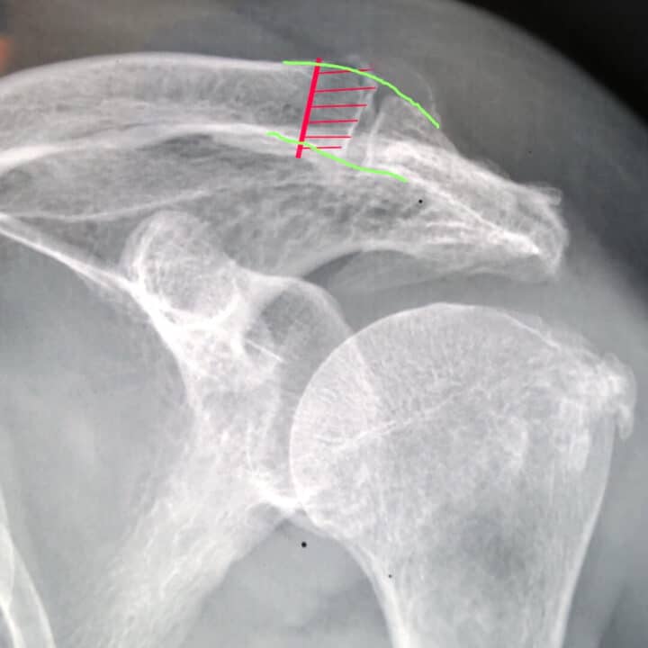 Arthrose acromio-claviculaire | Epaule | Pr Eric Roulot