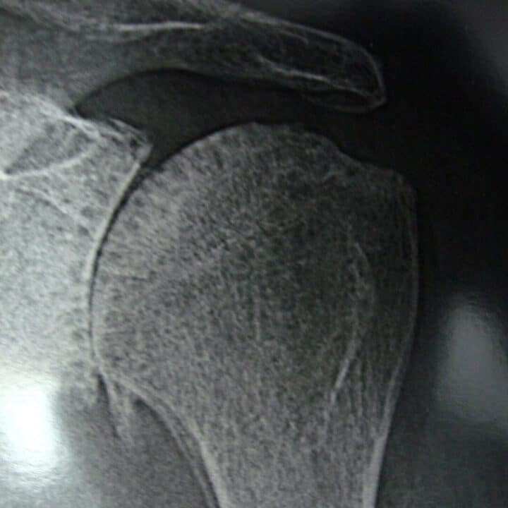 Omarthrose centrée et excentrée - Arthrose de l'épaule | Pr Eric Roulot