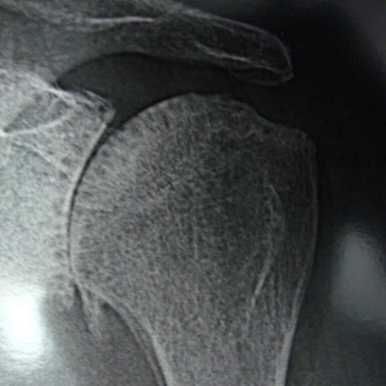 Omarthrose centrée et excentrée - Arthrose de l'épaule | Pr Eric Roulot