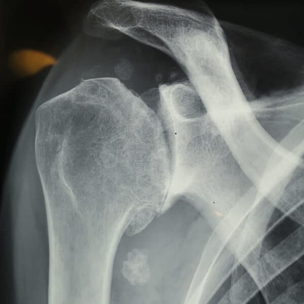 Omarthrose centrée et excentrée - Arthrose de l'épaule | Pr Eric Roulot