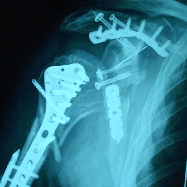 Omarthrose centrée et excentrée - Arthrose de l'épaule | Pr Eric Roulot