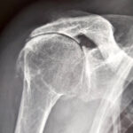 Omarthrose centrée et excentrée - Arthrose de l'épaule | Pr Eric Roulot