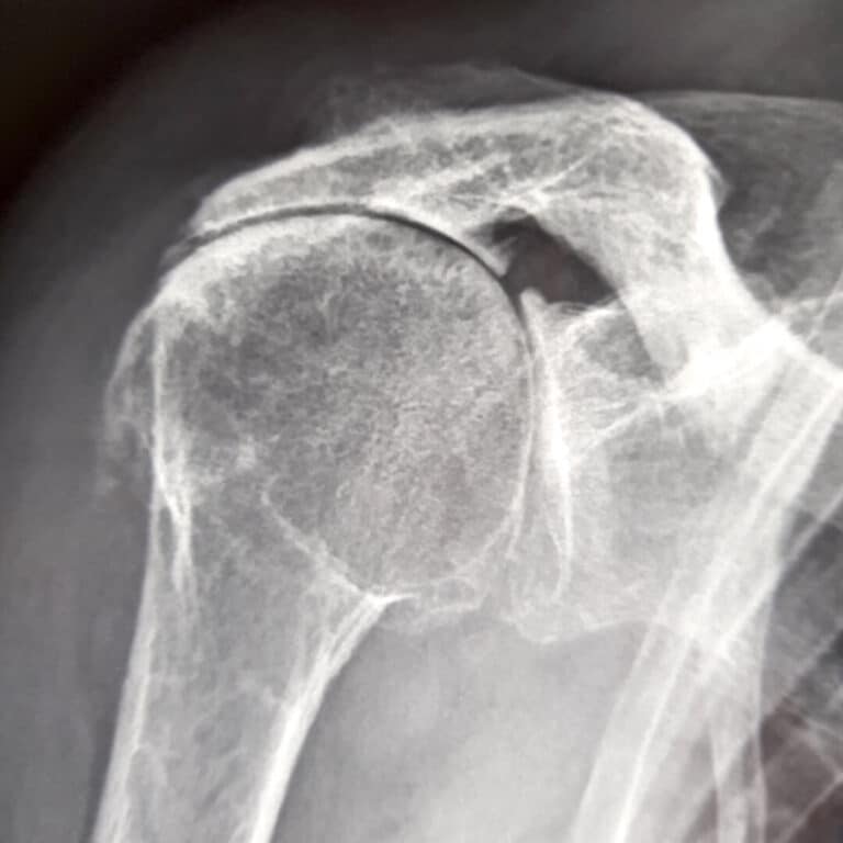 Omarthrose centrée et excentrée - Arthrose de l'épaule | Pr Eric Roulot