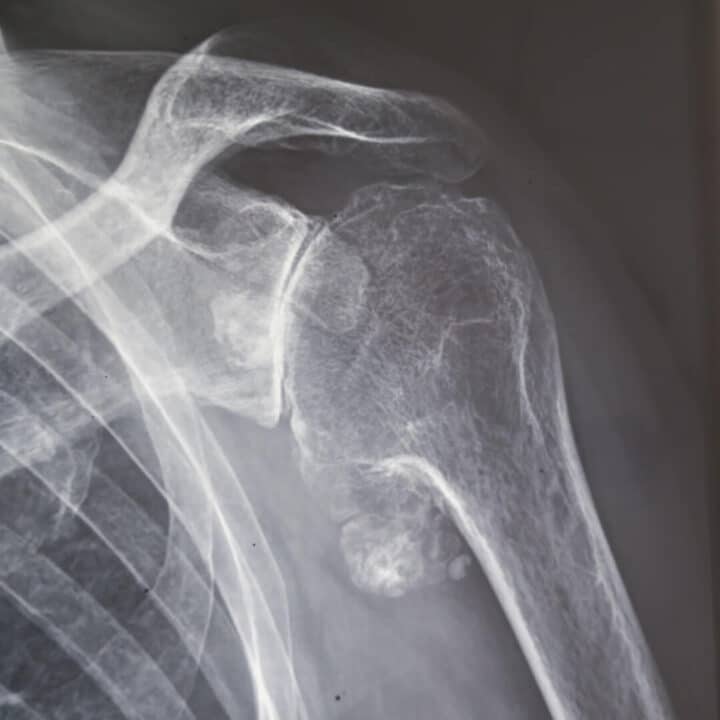 Omarthrose centrée et excentrée - Arthrose de l'épaule | Pr Eric Roulot