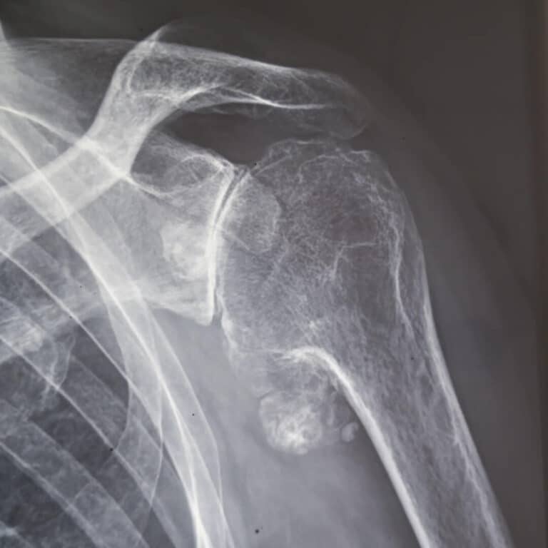 Omarthrose centrée et excentrée - Arthrose de l'épaule | Pr Eric Roulot