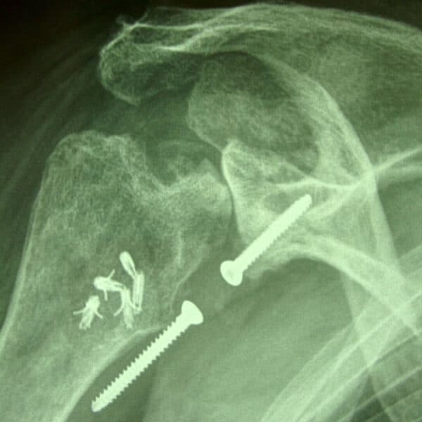 Prothèse d'épaule inversée et anatomique | Chirurgie orthopédique | Pr ...