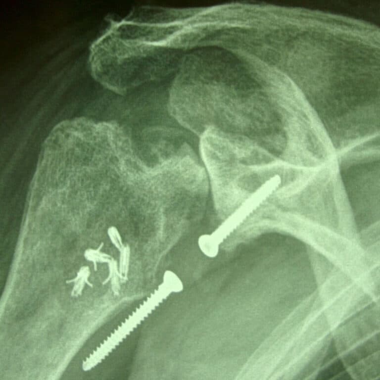 Prothèse d'épaule inversée et anatomique | Chirurgie orthopédique | Pr ...