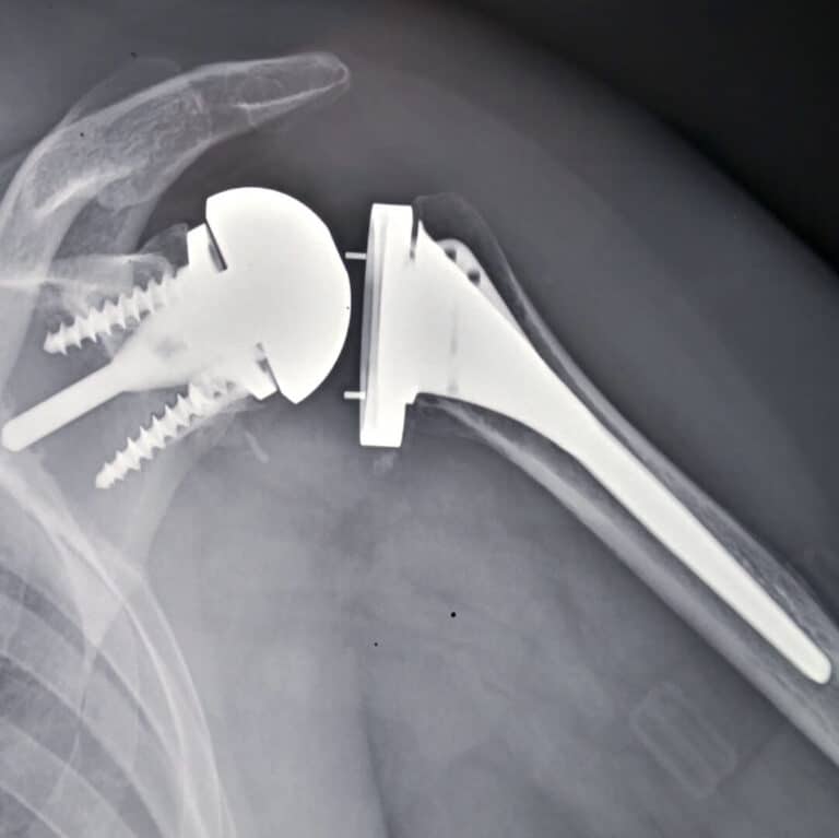 Prothèse d'épaule inversée et anatomique | Chirurgie orthopédique | Pr ...