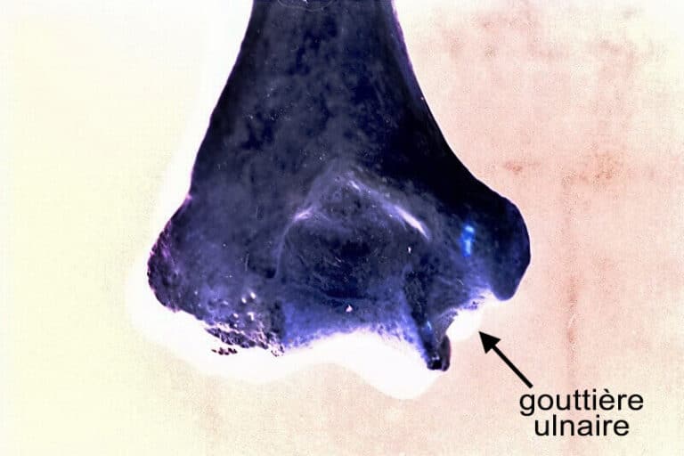 Nerf ulnaire au coude (nerf cubital) - Trajet, compression, libération ...
