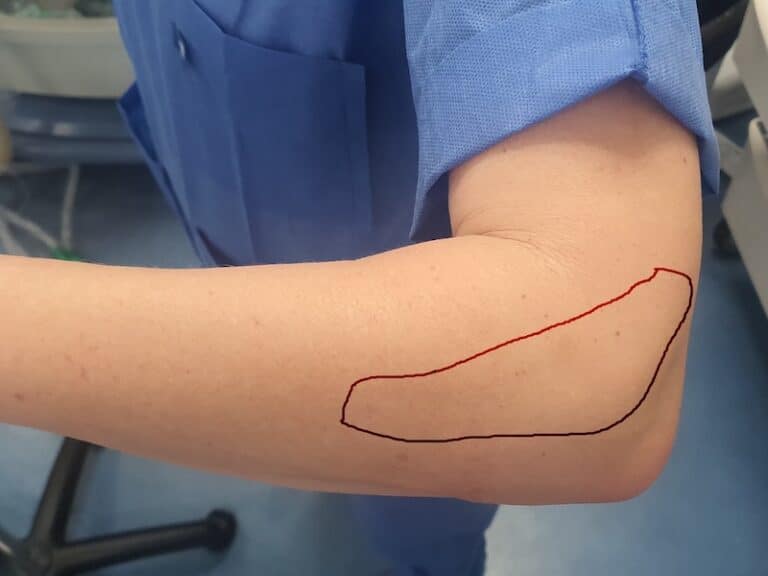 Epicondylite du coude ou tennis elbow | Tendinite coude | Pr Eric Roulot