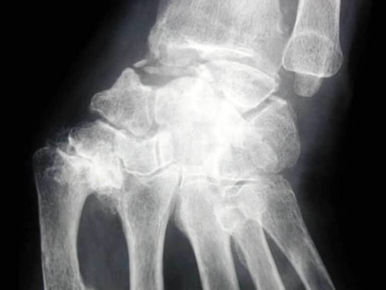 Fracture du scaphoïde | Traumatisme du poignet | Pr Eric Roulot