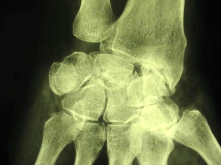 Fracture du scaphoïde | Traumatisme du poignet | Pr Eric Roulot