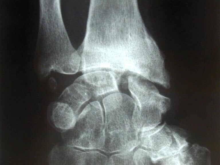 Fractures du poignet | Traumatismes main et poignet | Pr Eric Roulot