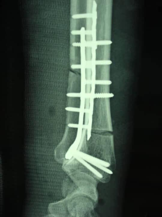 Fractures du poignet | Traumatismes main et poignet | Pr Eric Roulot