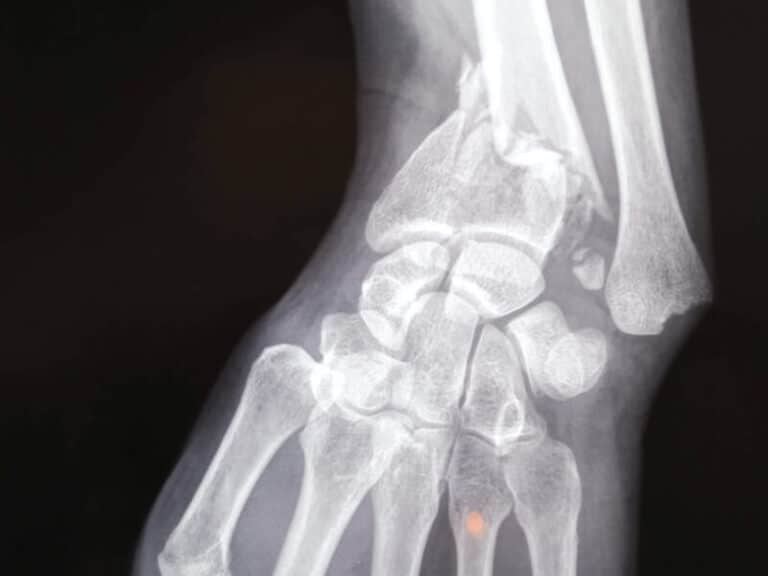 Fractures du poignet | Traumatismes main et poignet | Pr Eric Roulot