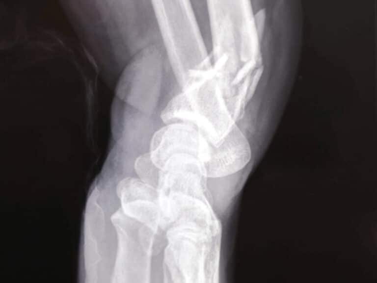 Fractures du poignet | Traumatismes main et poignet | Pr Eric Roulot