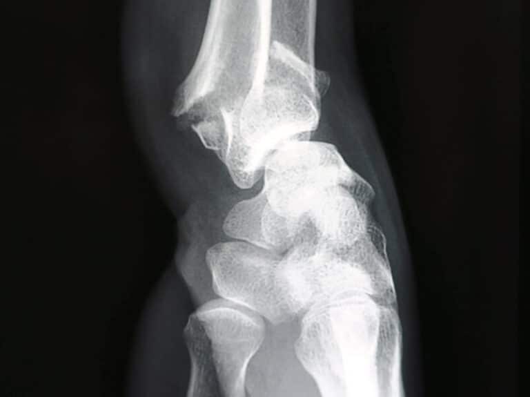Fractures du poignet | Traumatismes main et poignet | Pr Eric Roulot