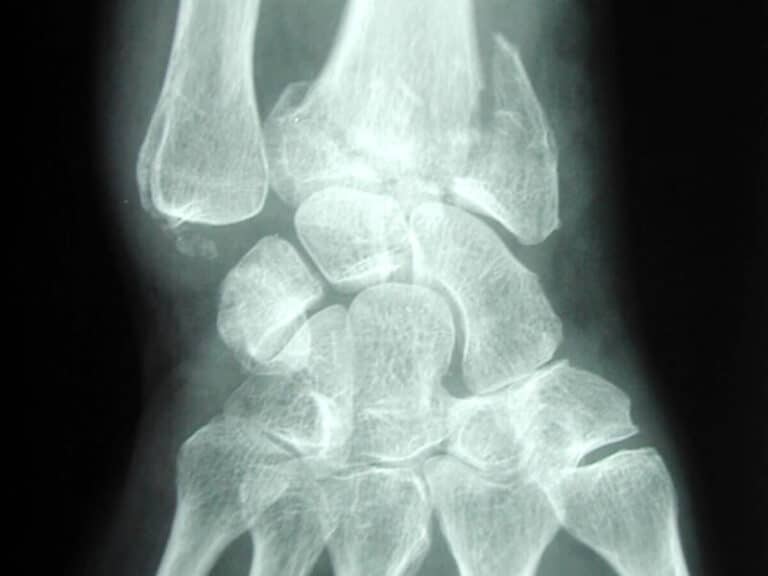 Fractures du poignet | Traumatismes main et poignet | Pr Eric Roulot