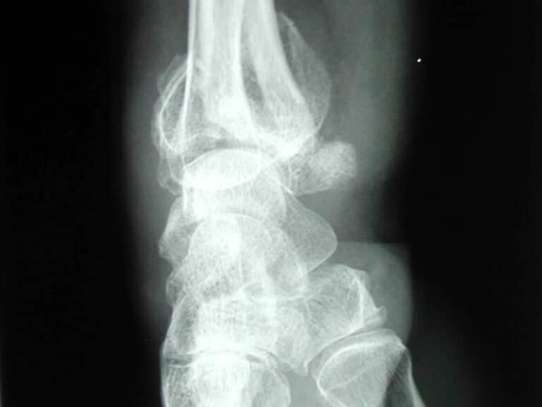 Fractures du poignet | Traumatismes main et poignet | Pr Eric Roulot