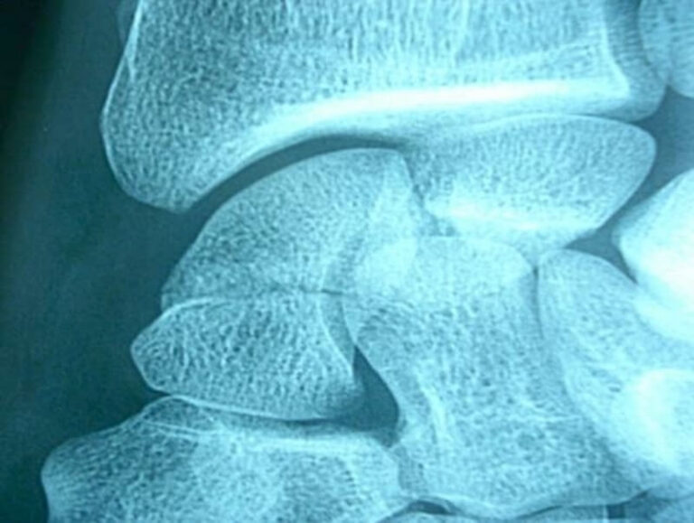 Fracture du scaphoïde | Traumatisme du poignet | Pr Eric Roulot
