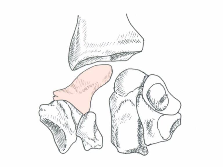 Fracture du scaphoïde | Traumatisme du poignet | Pr Eric Roulot